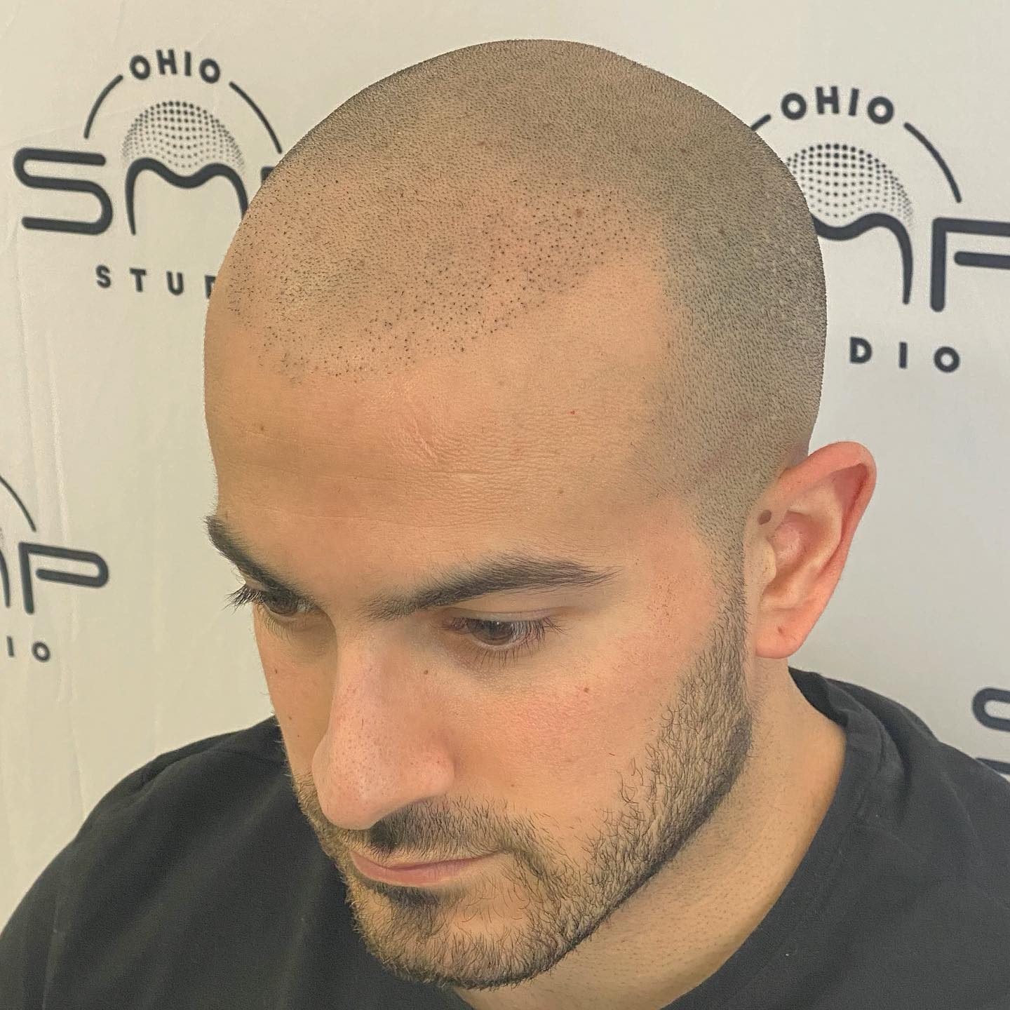 Understanding Mens Hair Loss And Effective Solutions A Comprehensive