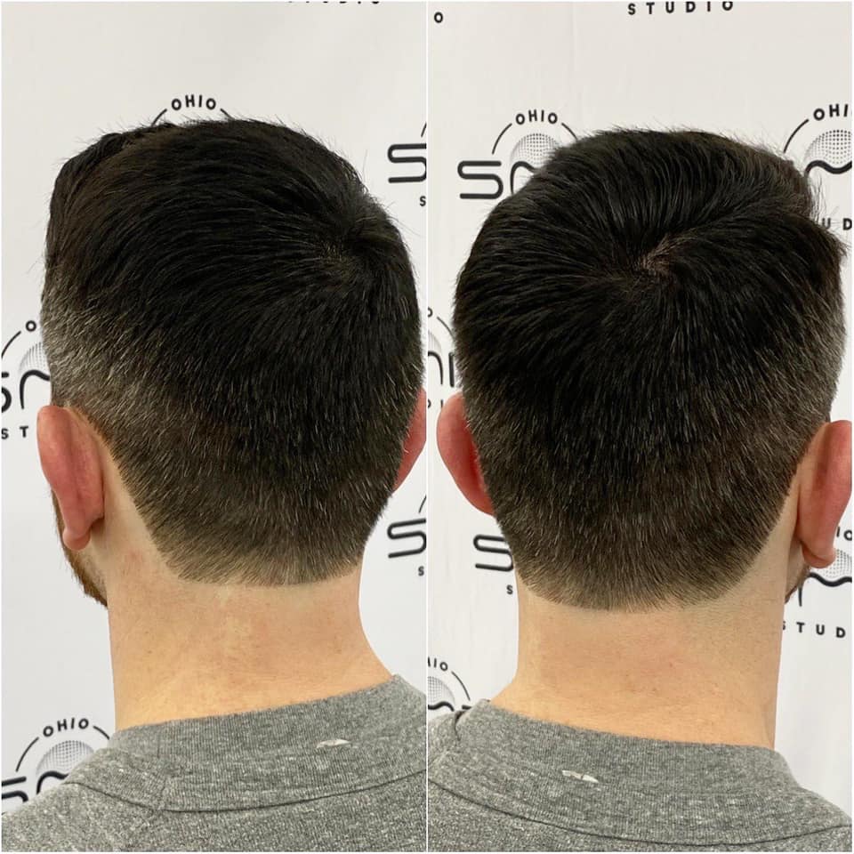 Receding Hairline Stages Signs Treatment